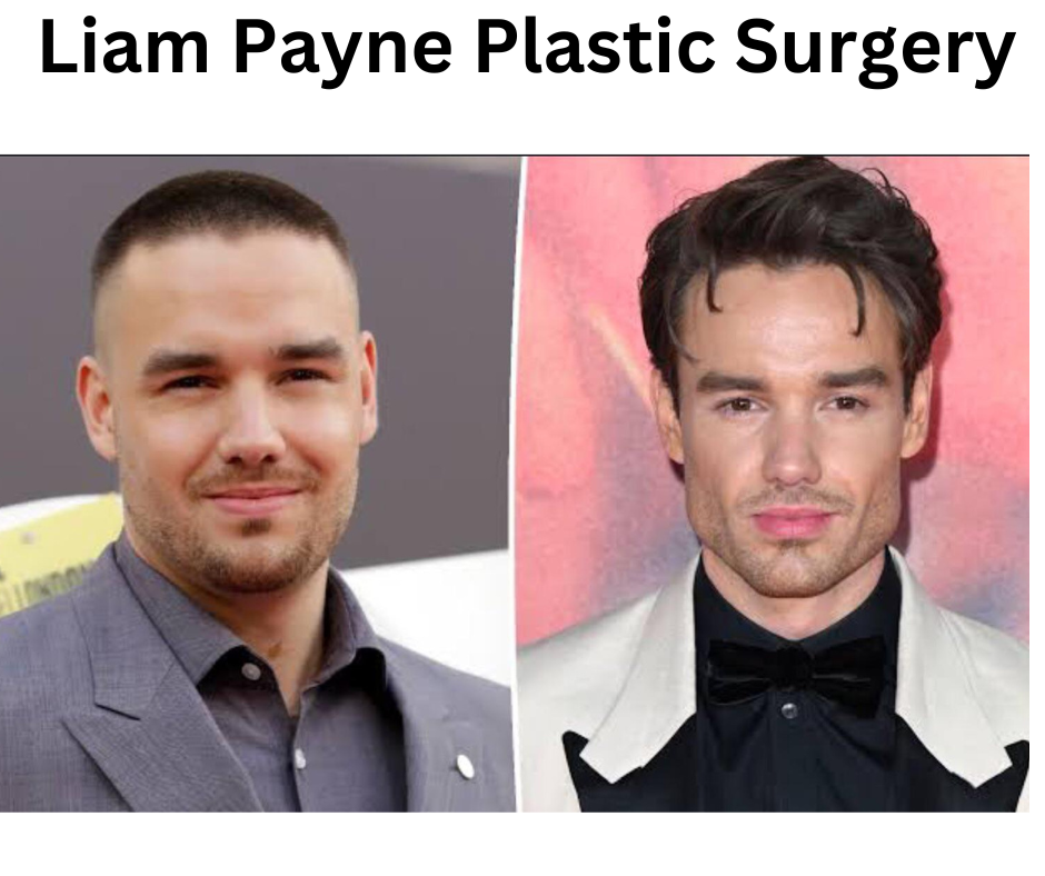 Liam Payne Plastic Surgery: Everything You Need to Know - Celebrity ...